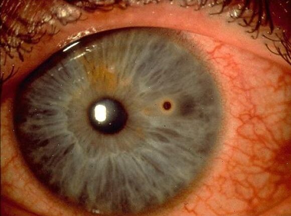 Foreign Body In Eye
