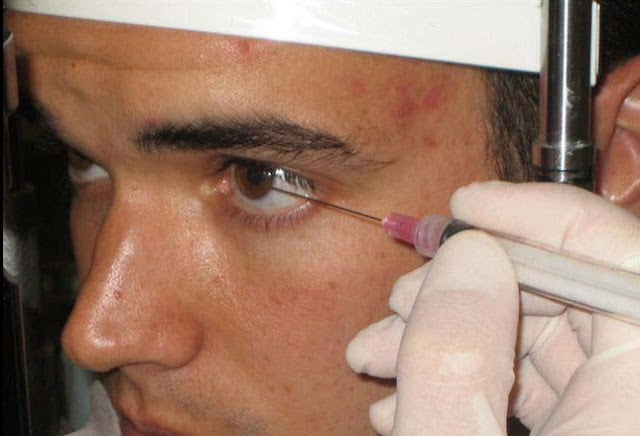 How to Remove a Foreign Body from the Eye - Eye Health Nepal