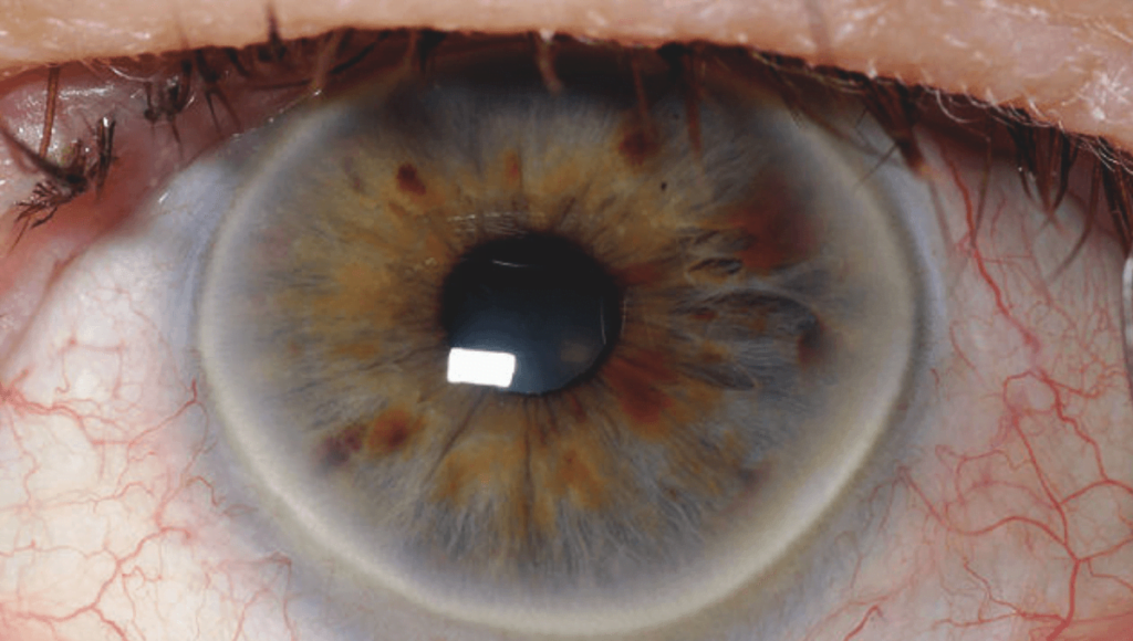 Rings in Ophthalmology - Eye Health Nepal