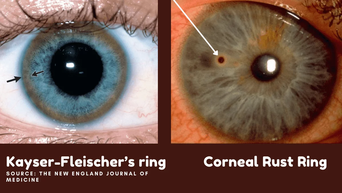 Corneal Rust Ring