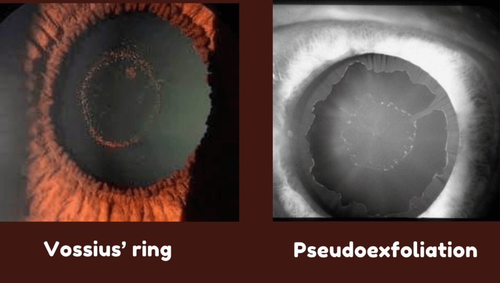 Rings in Ophthalmology - Eye Health Nepal