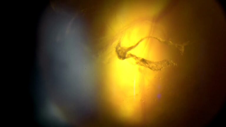 Rings in Ophthalmology - Eye Health Nepal