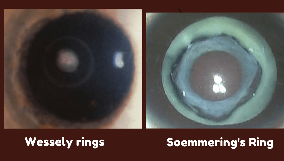 Rings in Ophthalmology - Eye Health Nepal