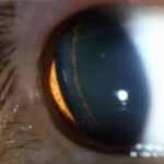 Rings in Ophthalmology - Eye Health Nepal