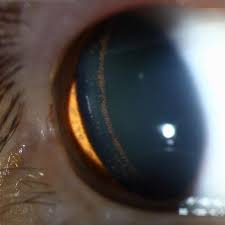 Rings in Ophthalmology - Eye Health Nepal