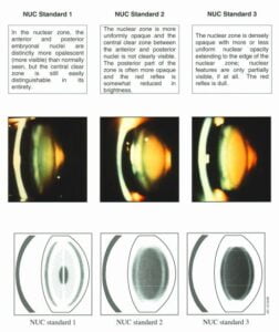 Grading In Ophthalmology - Eye Health Nepal