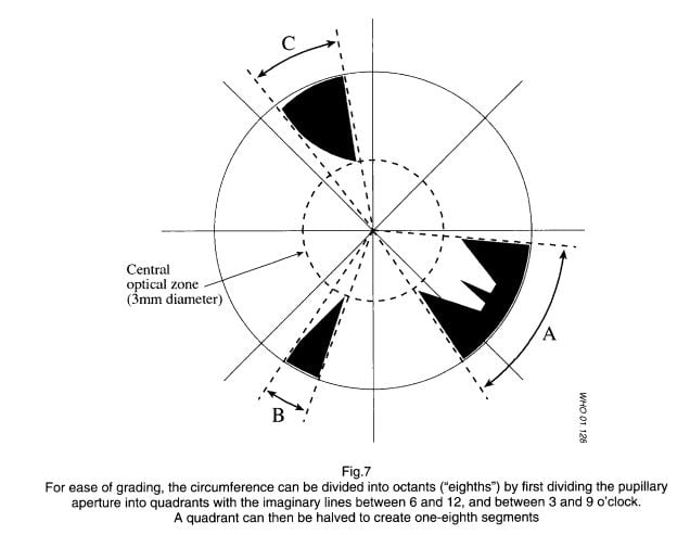 Grading In Ophthalmology - Eye Health Nepal