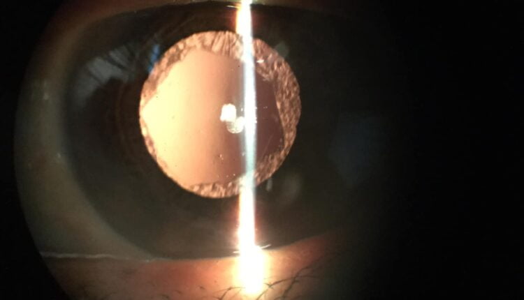 Slit Lamp Biomicroscope | Examination Procedure |Illumination ...