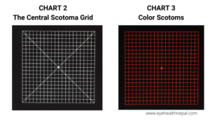 Amsler Grid Test Chart For Macular Disease - Eye Health Nepal