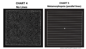 Amsler Grid Test Chart For Macular Disease - Eye Health Nepal