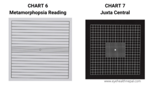 Amsler Grid Test Chart For Macular Disease - Eye Health Nepal