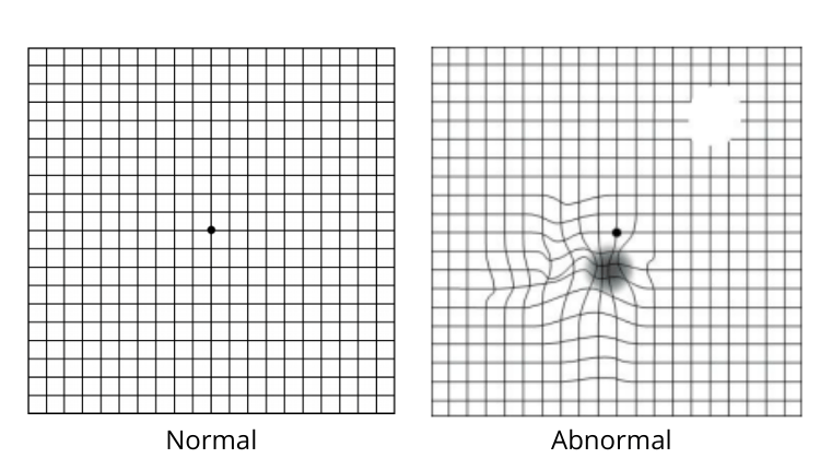 Amsler Grid Test Chart For Macular Disease - Eye Health Nepal