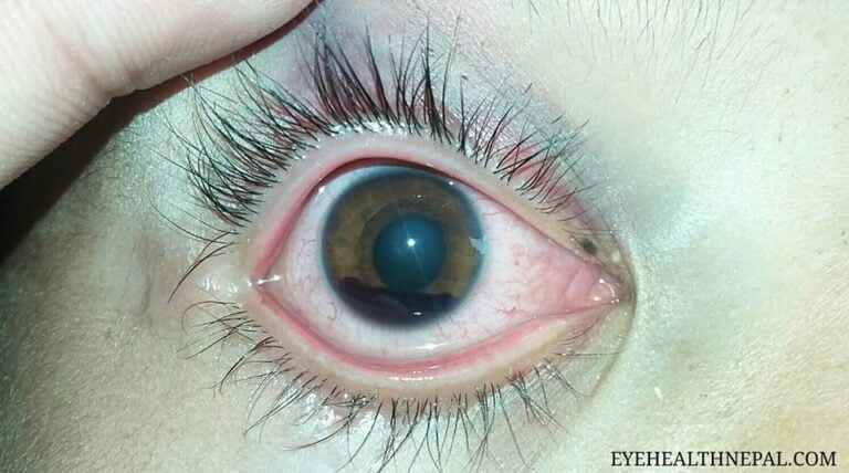 What is Hyphema? How to Treat Hyphema and its Complications - Eye ...