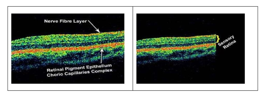 What is Optical Coherence Tomography (OCT)? Basic Interpretation ...