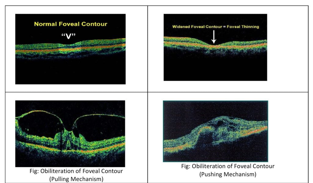 What is Optical Coherence Tomography (OCT)? Basic Interpretation ...