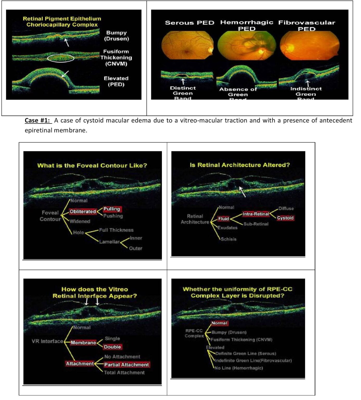 What is Optical Coherence Tomography (OCT)? Basic Interpretation ...