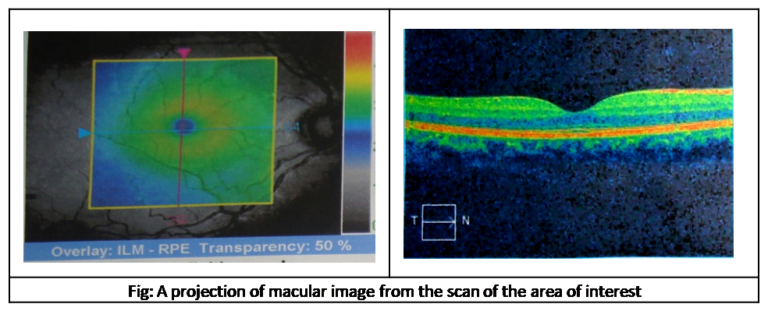 What is Optical Coherence Tomography (OCT)? Basic Interpretation ...