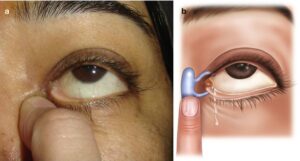 Lacrimal Syringing, Procedure, Result, Indication and Contraindications ...