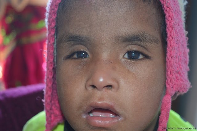 Global Blindness and causes : Top Blinding Disease in the World - Eye ...