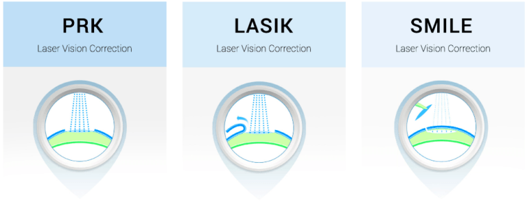LASIK, SMILE Eye Surgery Cost in Nepal (Refractive Eye Surgery) - Eye ...