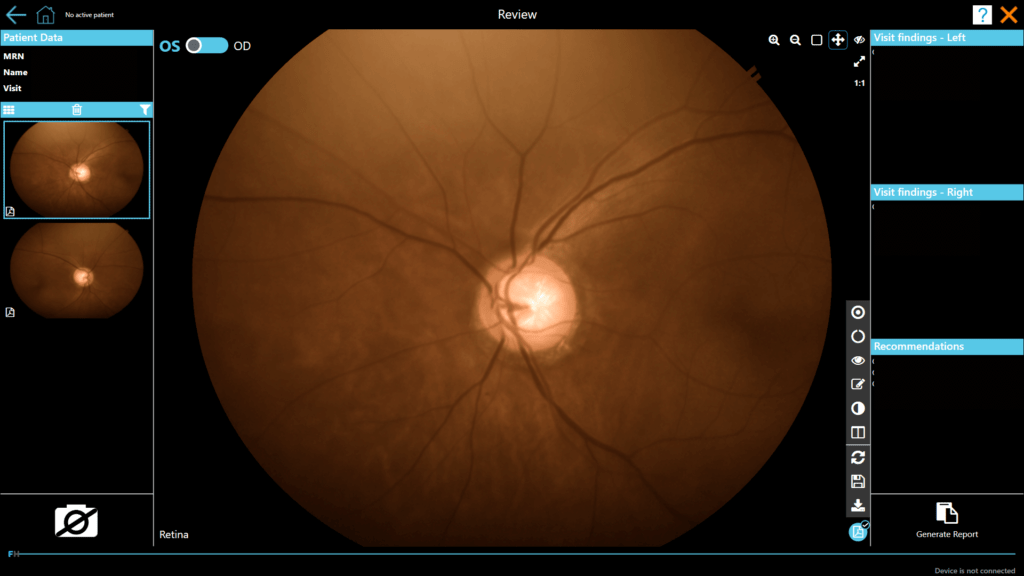 Review of 3nethra Classic Digital Non-mydriatic Fundus Camera - Eye ...