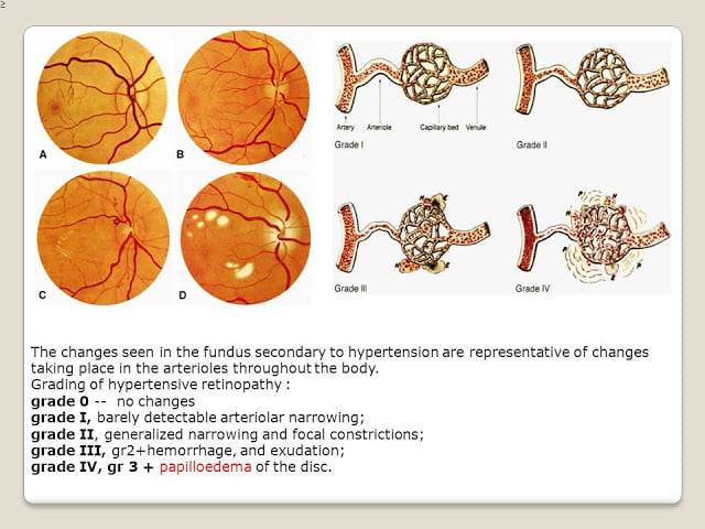 Grading In Ophthalmology - Eye Health Nepal