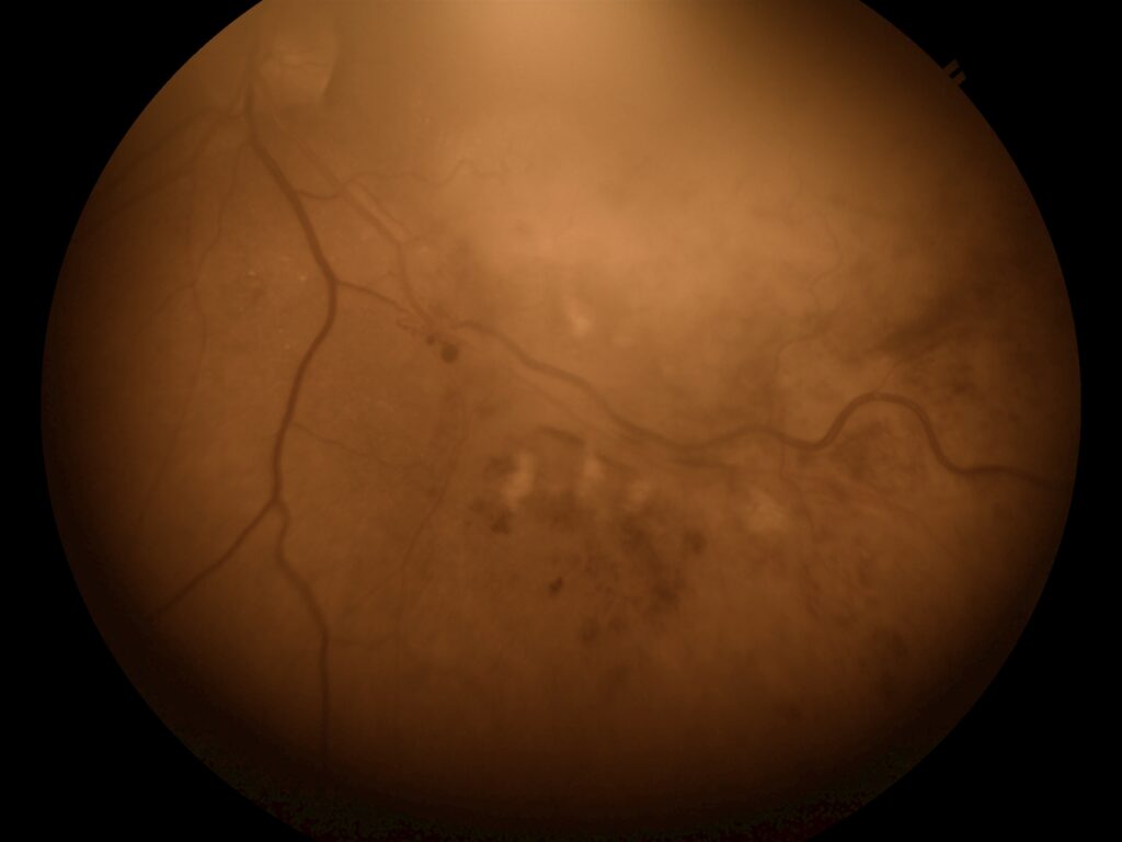 Review of 3nethra Classic Digital Non-mydriatic Fundus Camera - Eye ...
