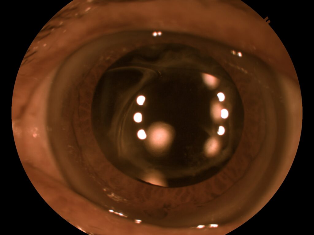Review of 3nethra Classic Digital Non-mydriatic Fundus Camera - Eye ...