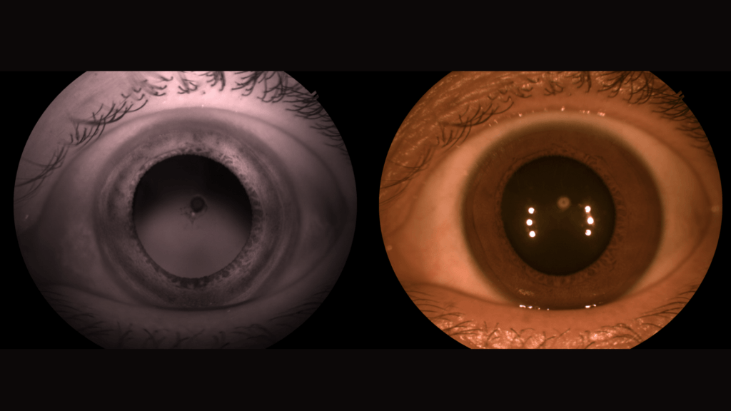 Review of 3nethra Classic Digital Non-mydriatic Fundus Camera - Eye ...